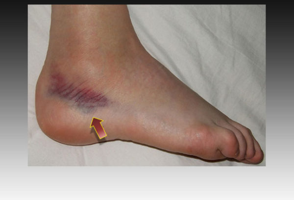 Common pediatric recreation and sport's injuries
