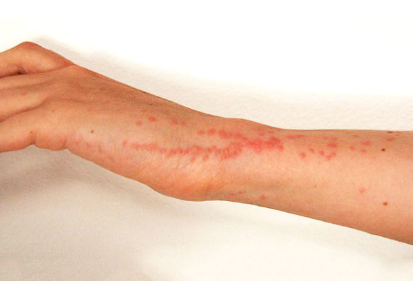 Bed bugs, Mites and Lice - human skin infestions - treatment